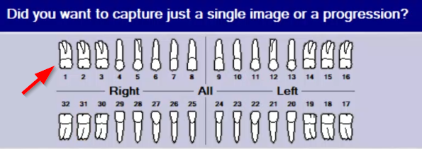XV Capture: Switching between Gendex and IXS Sensors. – Interdent IT